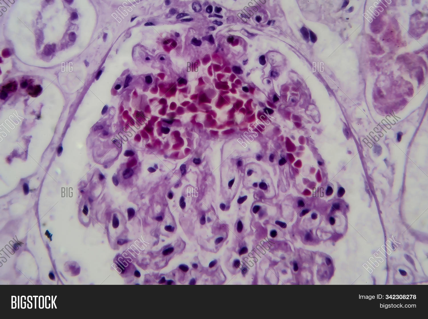 Acute Glomerulonephritis, Light Micrograph, Photo Under Microscope ...