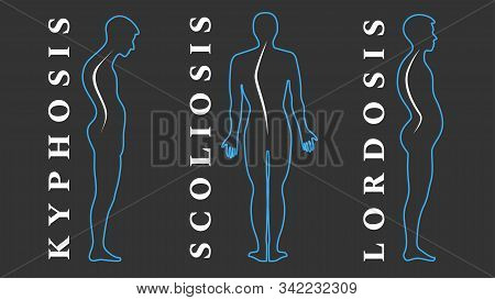 Diseases Of The Spine. Scoliosis, Lordosis, Kyphosis. Body Posture ...
