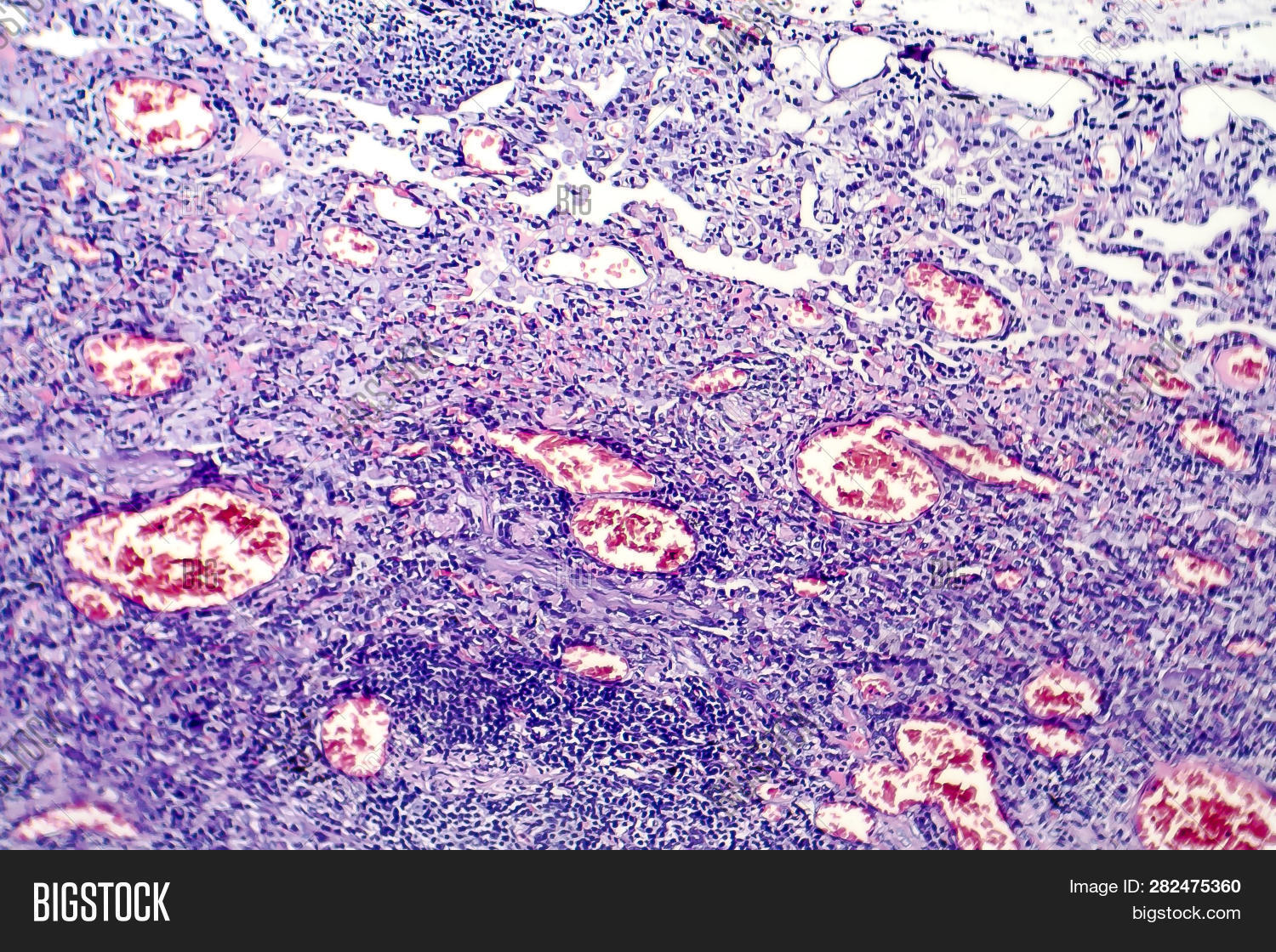 Histopathology Of Tuberculosis, Light Micrograph Of Tuberculosis Lesion ...