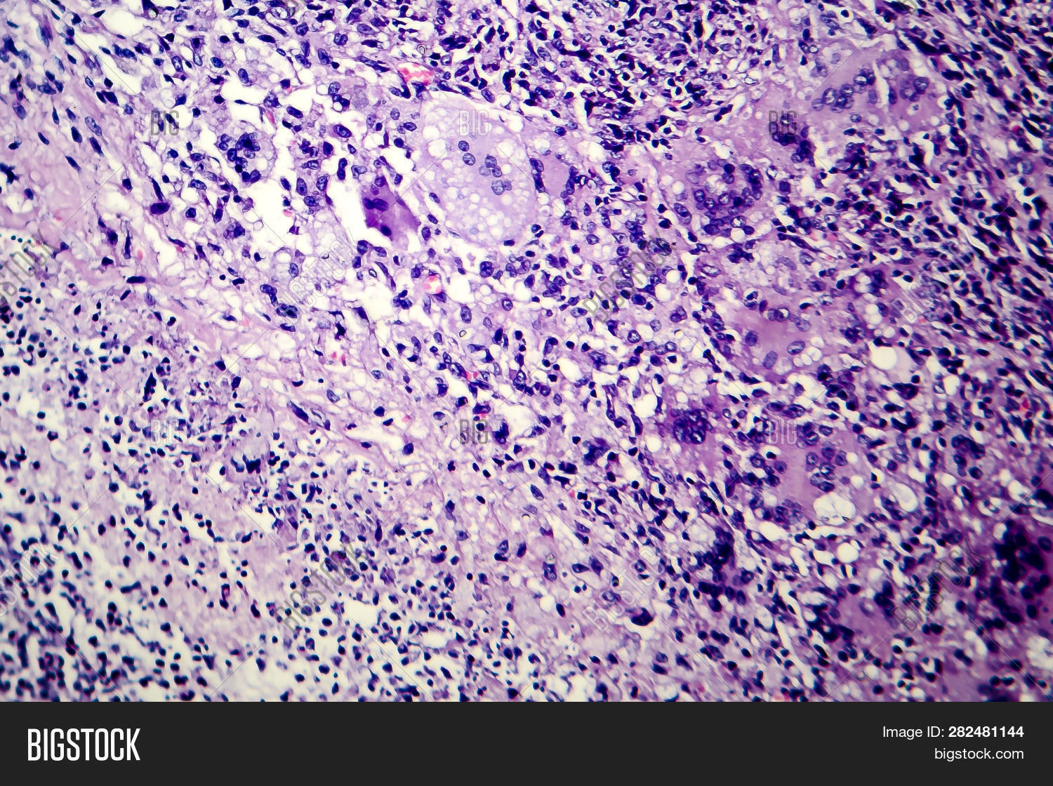 Histopathology Of Tuberculosis, Light Micrograph Of Tuberculosis Lesion ...