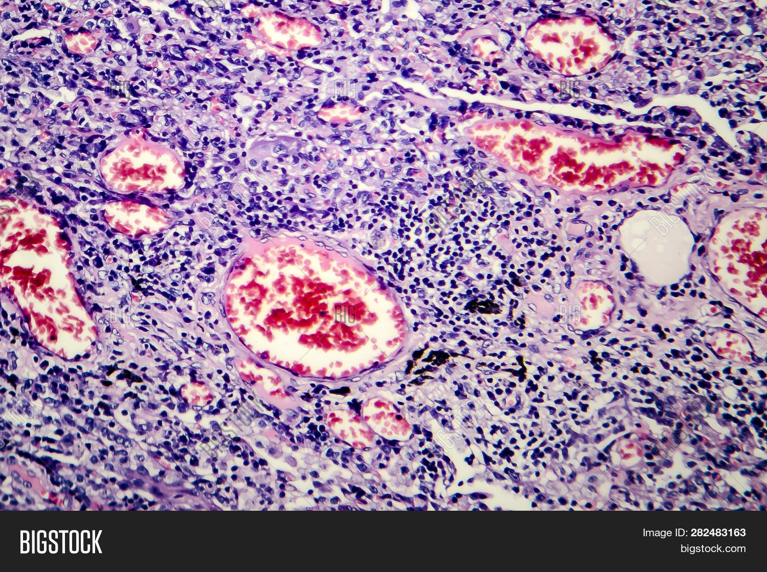 Histopathology Of Tuberculosis, Light Micrograph Of Tuberculosis Lesion ...