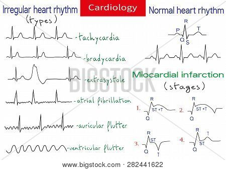 Normal And Pathological Ecg Collection. Shematic Vector Illustration Of ...