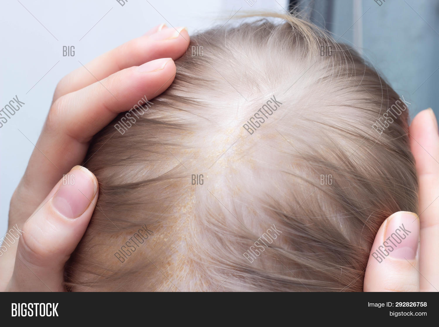 Fungal Skin Disease Seborrheic Dermatitis In A Childs Head, Close-up ...