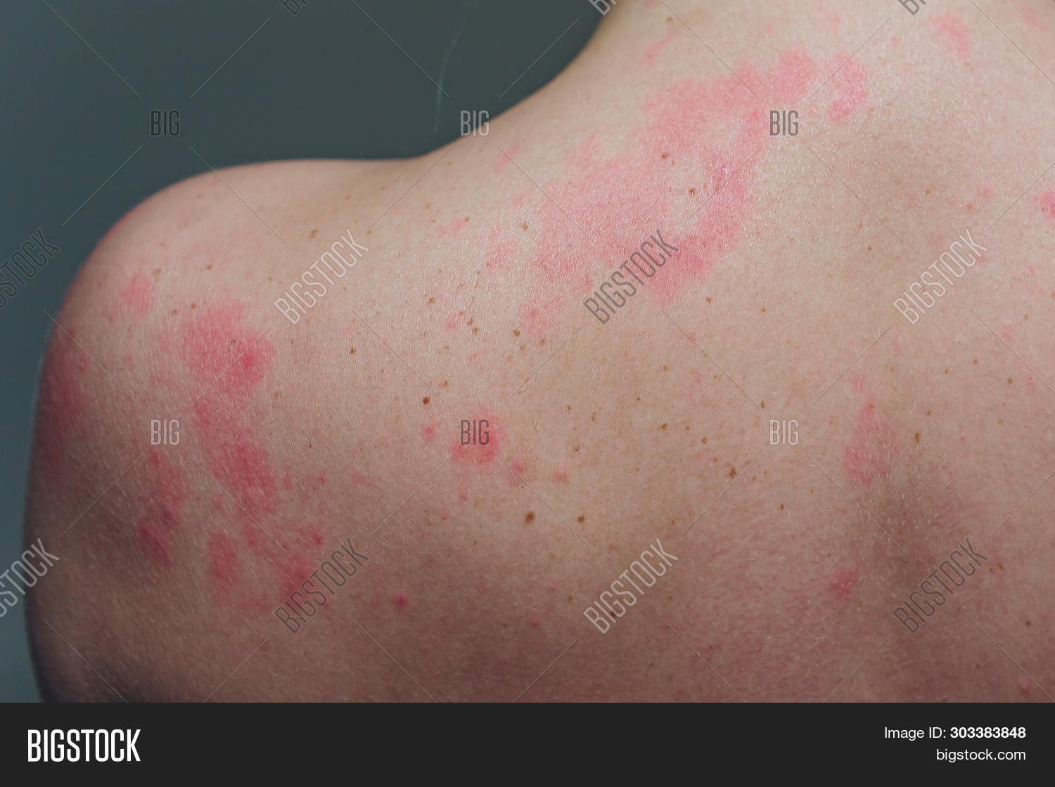 Close Up Allergy Rash, Around Back View Of Human With Dermatitis ...