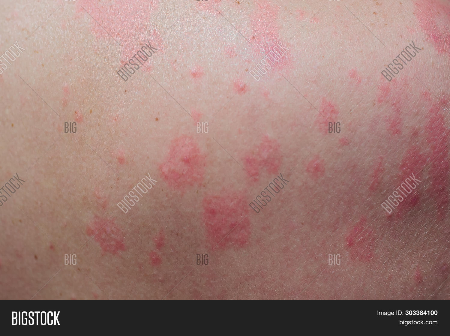 Close Up Allergy Rash, Around Back View Of Human With Dermatitis ...