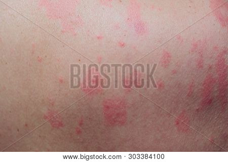 Close Up Allergy Rash, Around Back View Of Human With Dermatitis Problem Of Rash , Allergy Rash ...