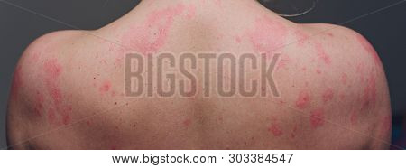 Close Up Allergy Rash, Around Back View Of Human With Dermatitis Problem Of Rash , Allergy Rash ...