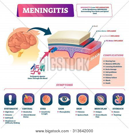Meningitis Vector Illustration. Medical Labeled Brain Covering Membrane ...