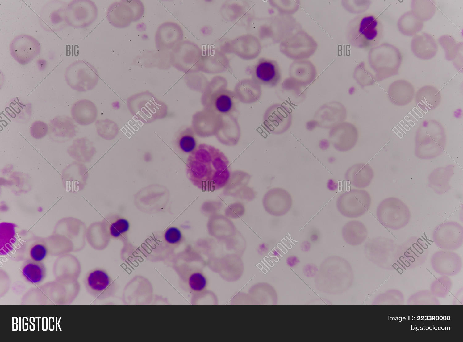 Blood Smear Thalassemia Patient. image & stock photo. 223390000