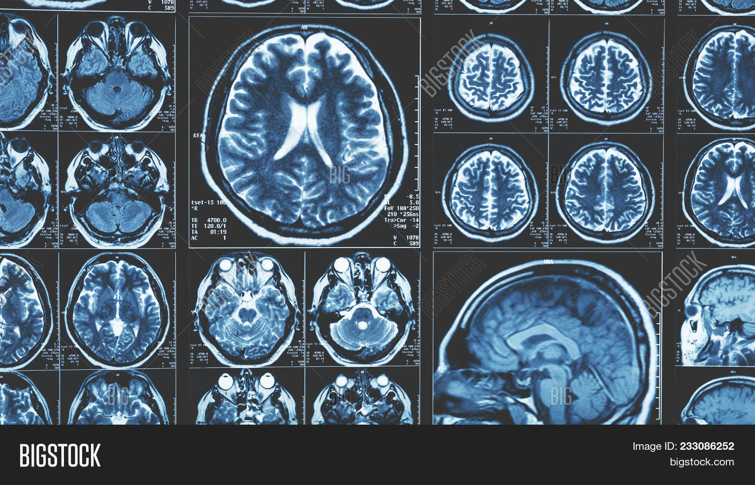 Mri Brain Scan Background, Magnetic Resonance Tomography, Blue Toned ...