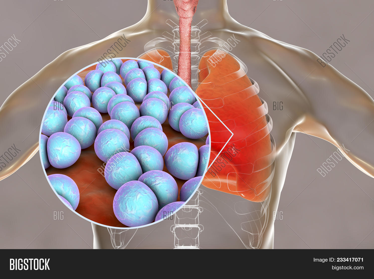 Pneumococcal Pneumonia, Medical Concept. 3d Illustration Showing ...