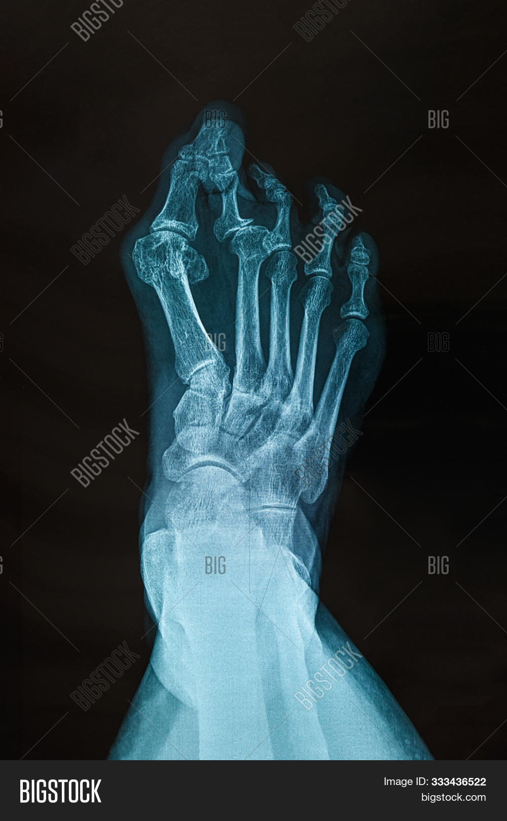 X-ray Of The Right Foot. Transverse Plane Deviation, Crossover Second ...