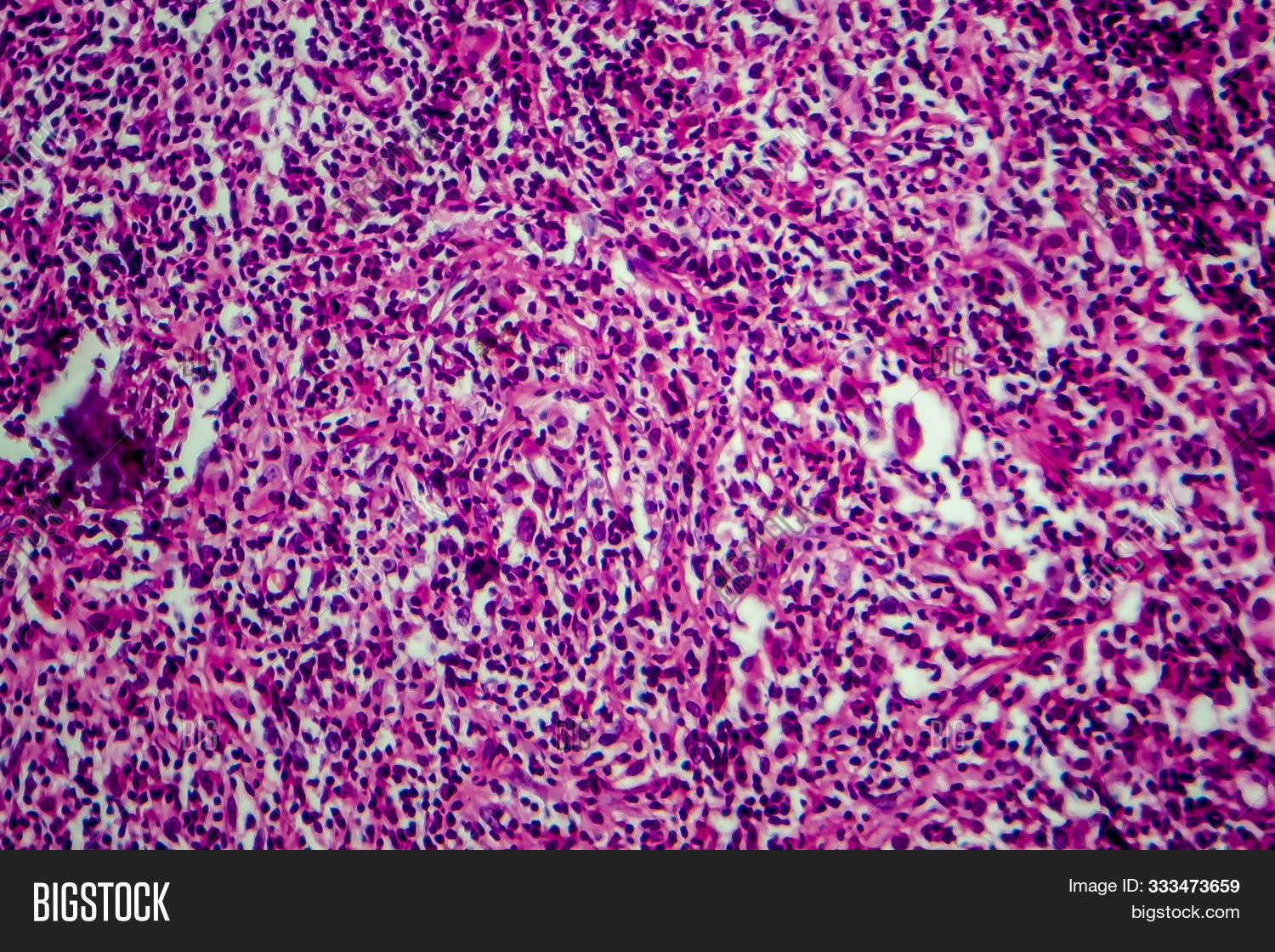 Hodgkins Lymphoma, Light Micrograph, Photo Under Microscope image ...