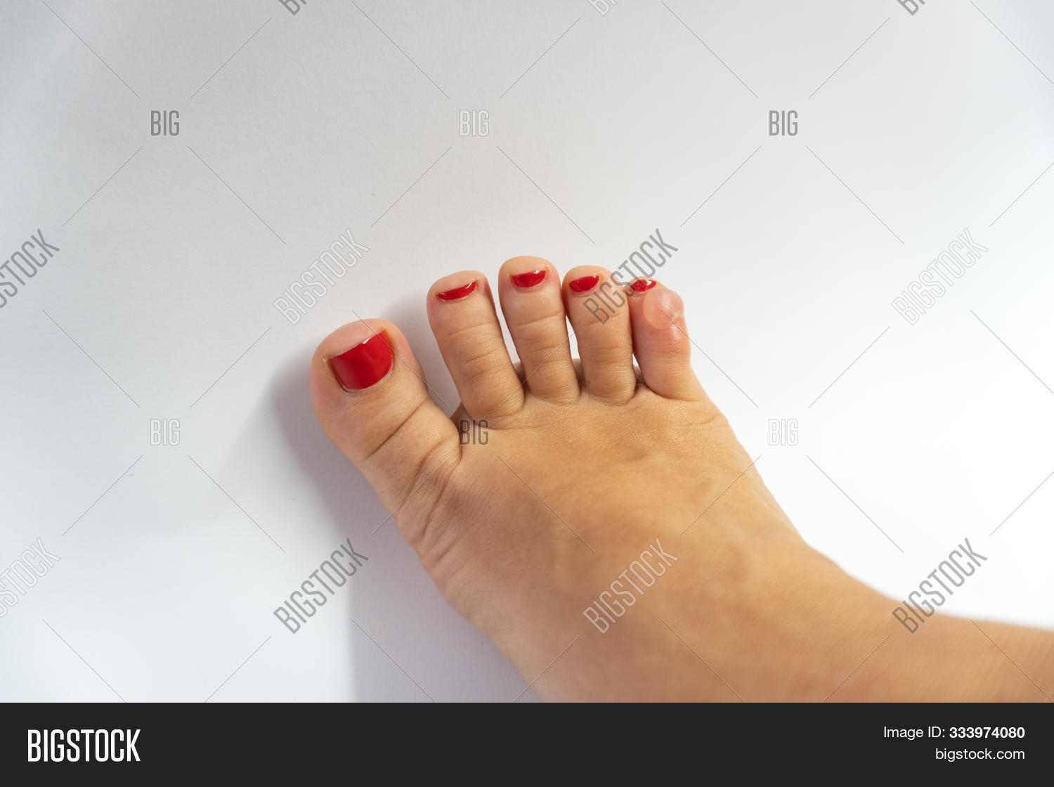 Huge Water Foot Corn On A Pinky Toe At Woman Led, Close Up Of A Callus ...