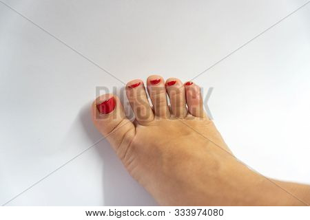 Huge Water Foot Corn On A Pinky Toe At Woman Led, Close Up Of A Callus ...