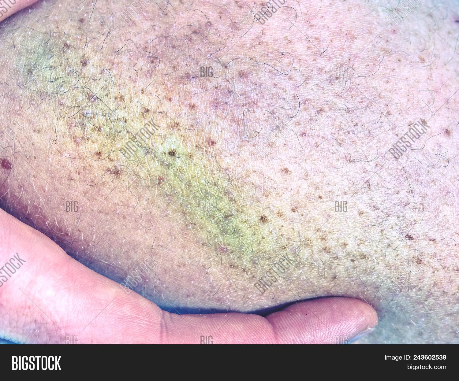 Hand Embracing Injured Leg With Painful Hematoma And Scratches From ...