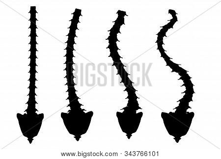Types Of Scoliosis. C, S, Z Shaped Scoliosis. Dextroscoliosis ...