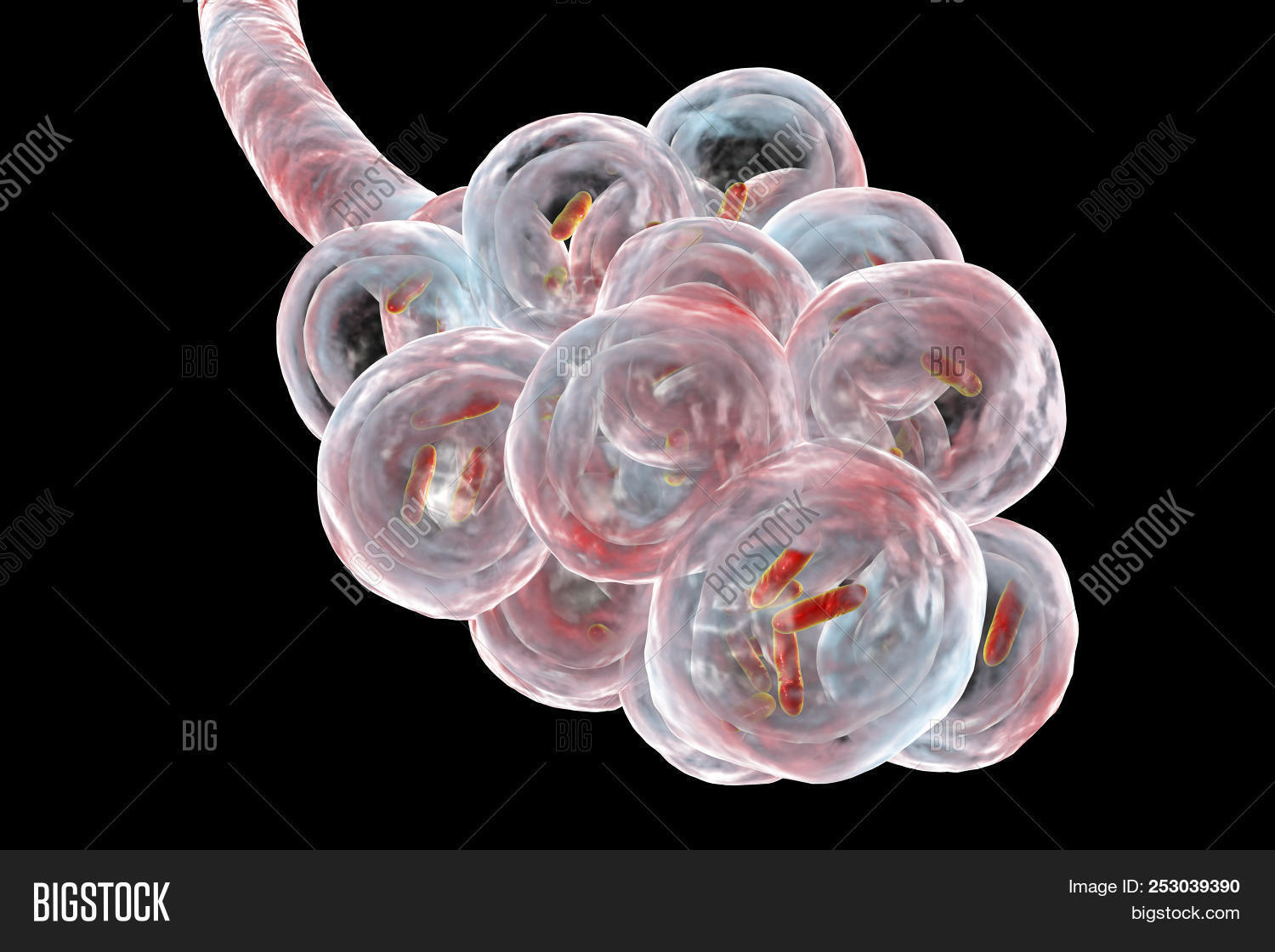 Bacterial Pneumonia, Medical Concept. 3d Illustration Showing Rod ...