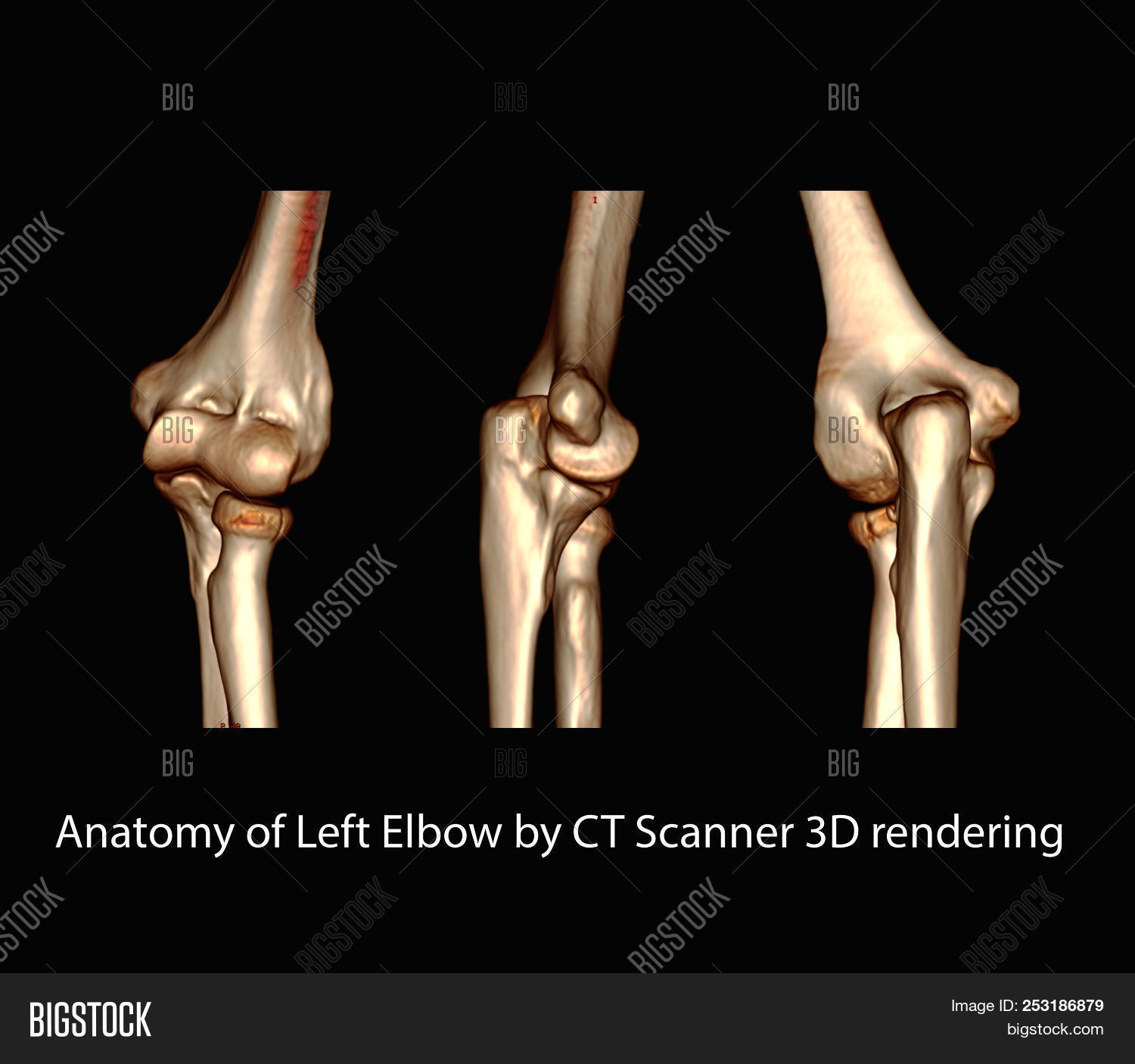 Anatomy Of Left Elbow By Ct Scanner 3d Rendering . Medical Technology ...