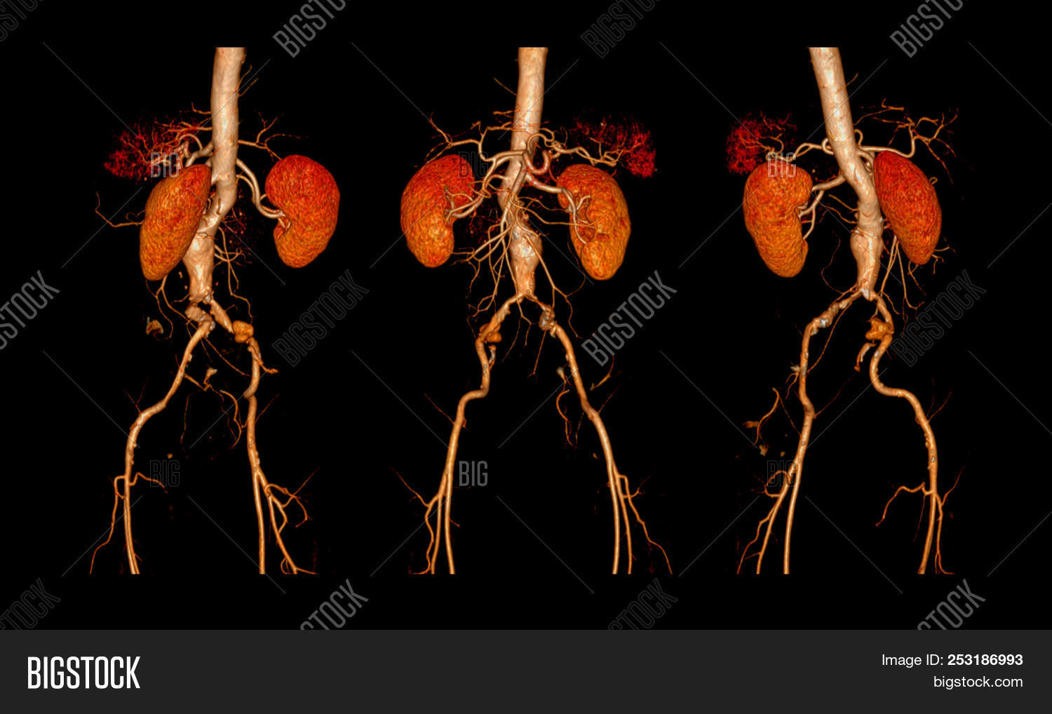 Cta Abdominal Aorta And Femoral Run Off Findings: Infrarenal Aortic ...