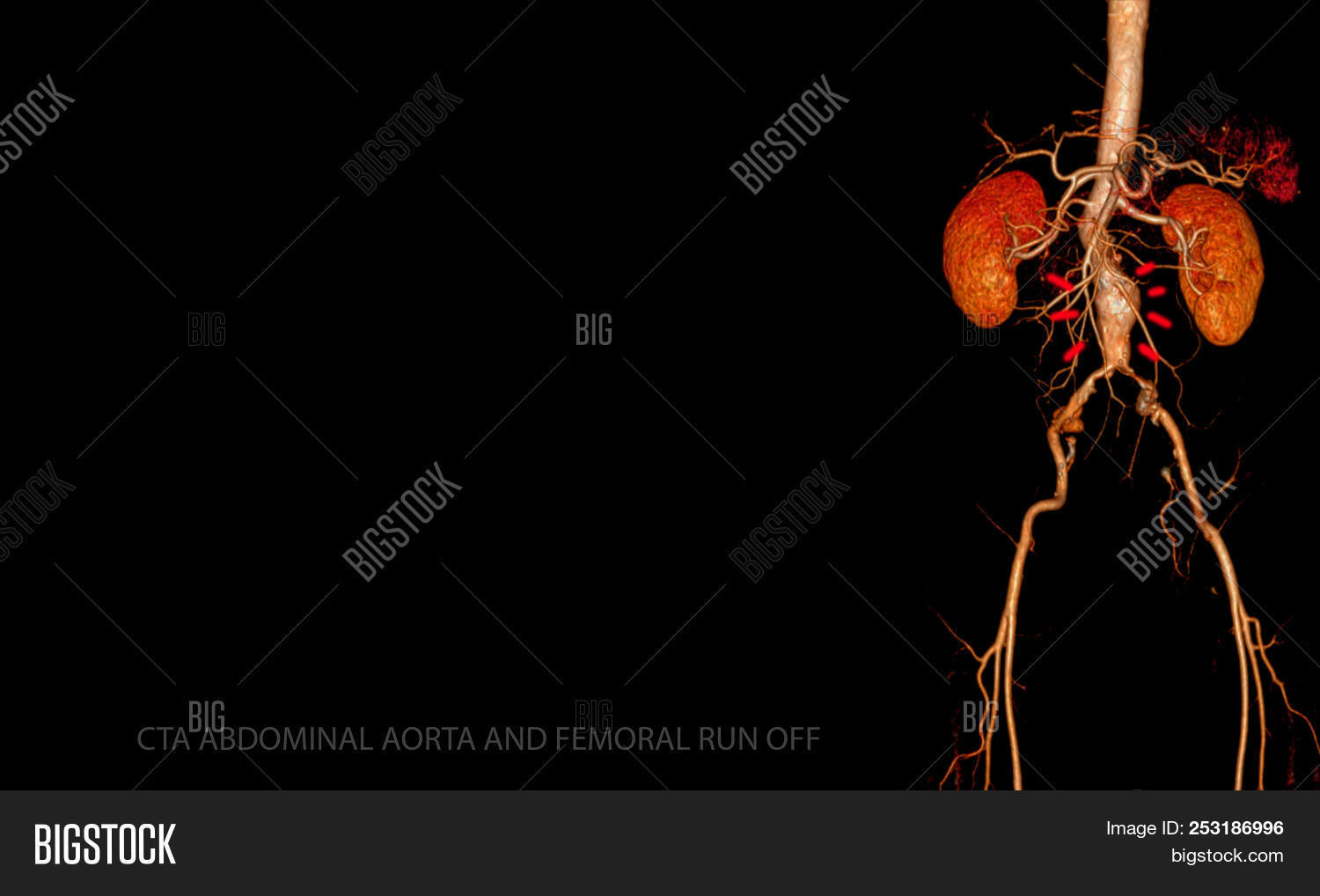 Cta Abdominal Aorta And Femoral Run Off Findings: Infrarenal Aortic ...
