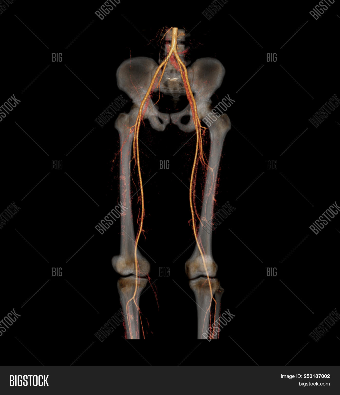 Ct Scan 2d And 3d Rendering Of Lower Extremity. Cta Femoral Artery Run ...