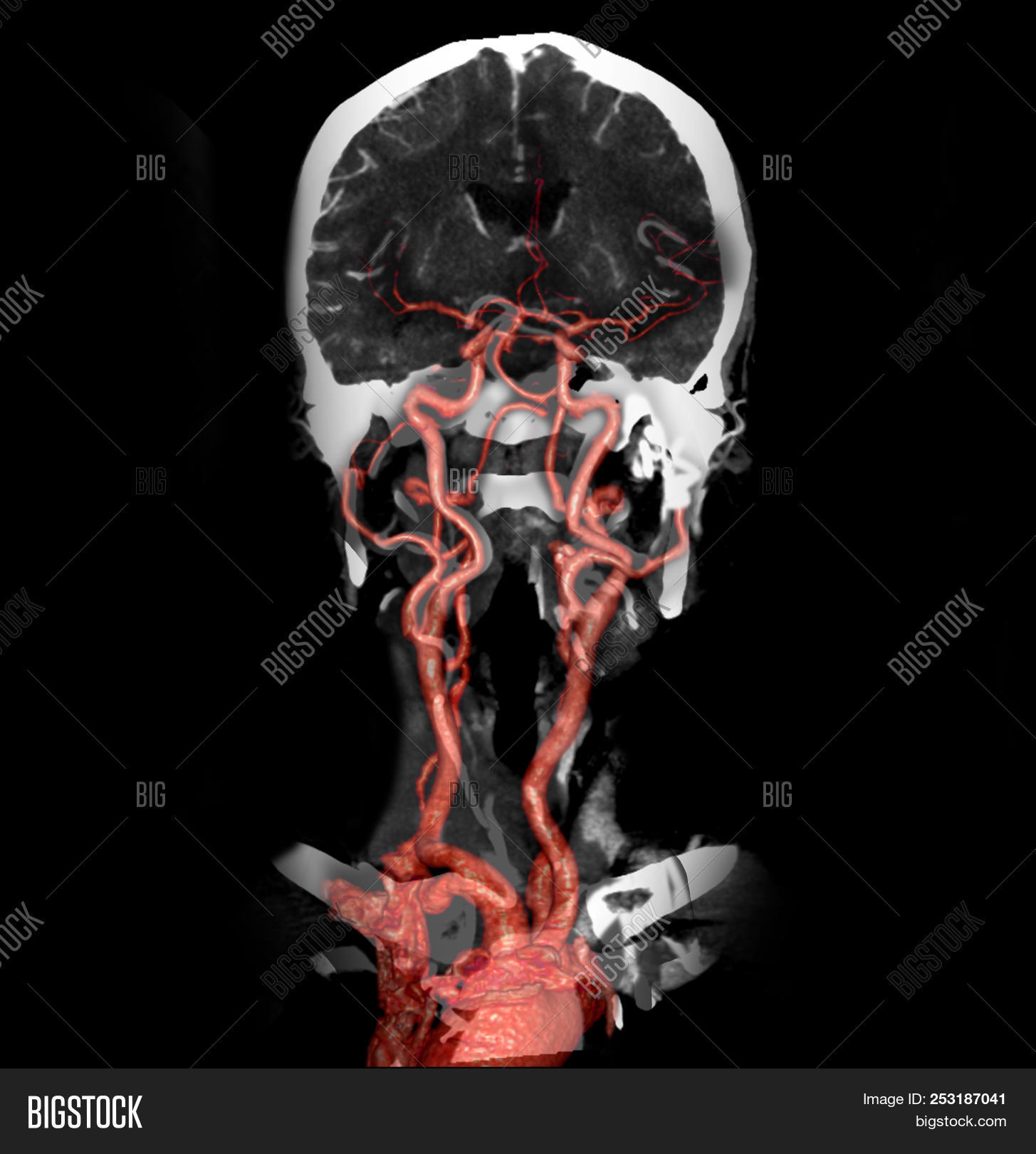 Multi View 2d And 3d Rendering Image Of Ct Angiography Showing Normal ...