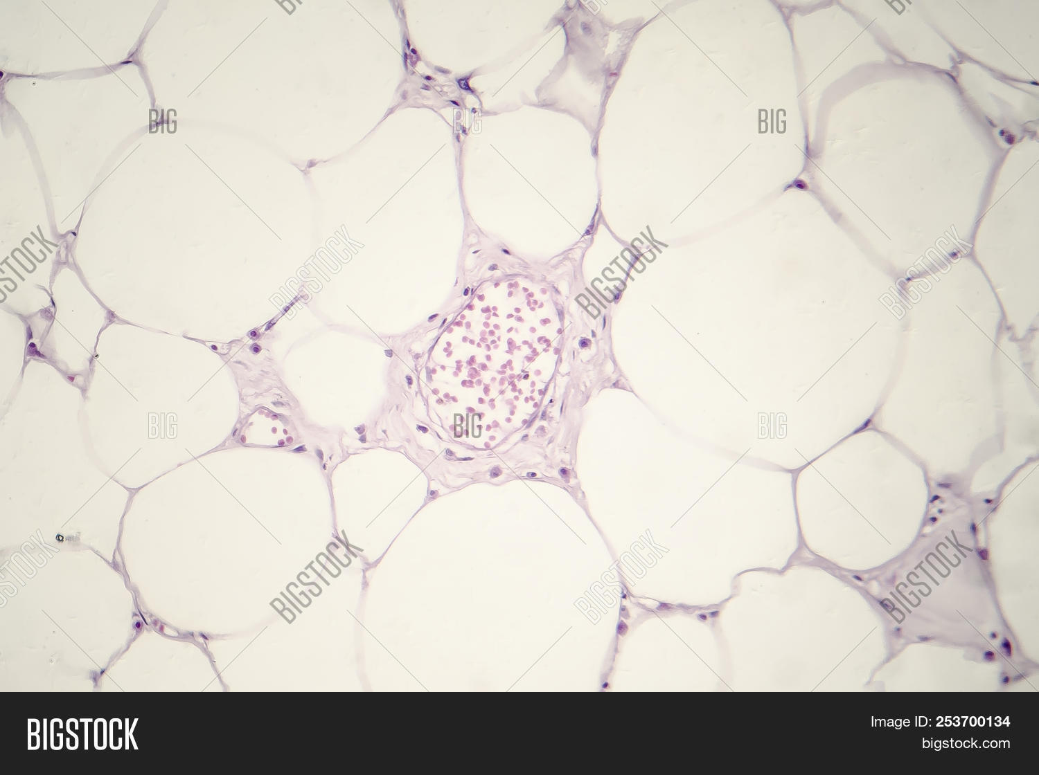 Lipoma, Benign Growth Of Fatty Tissue, Light Micrograph, Photo Under ...