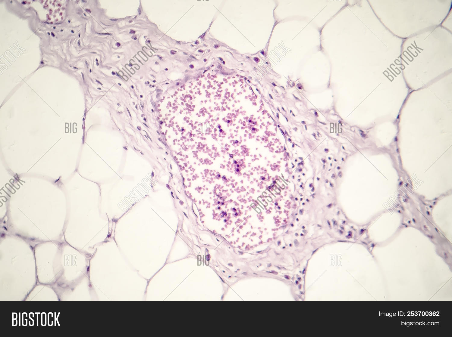 Lipoma, Benign Growth Of Fatty Tissue, Light Micrograph, Photo Under ...