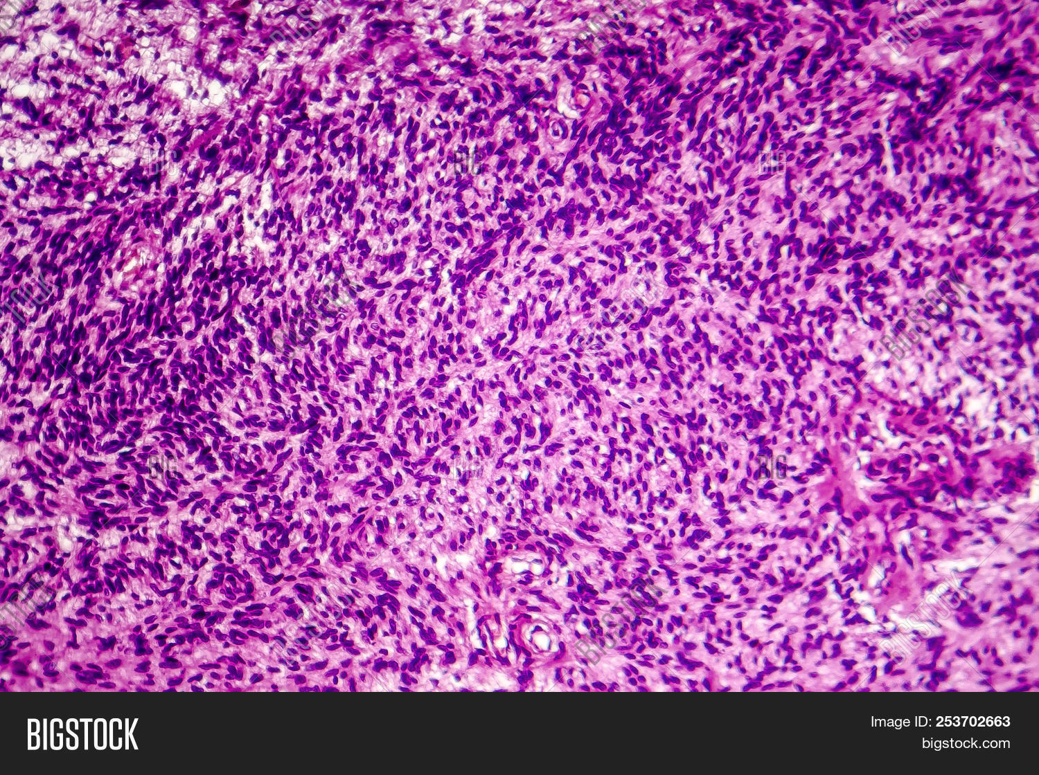 Fibrosarcoma, Malignant Tumor Of Fibroblasts, One Of Soft Tissue ...