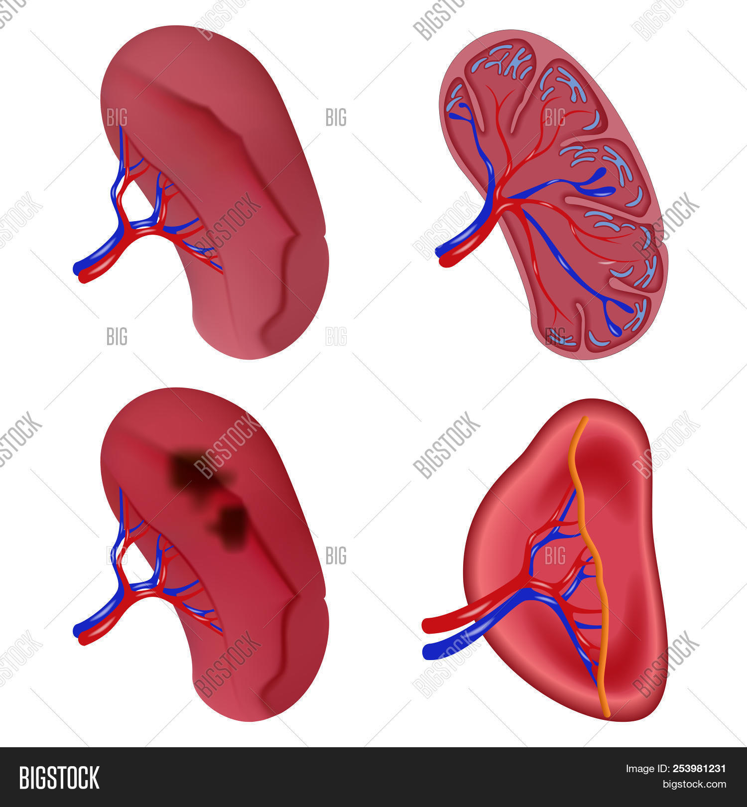 Spleen Milt Anatomy Icons Set. Realidtic Illustration Of 4 Spleen Milt ...