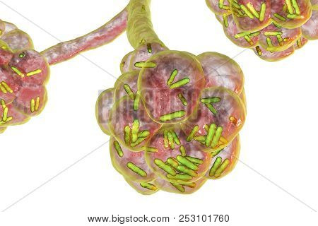 Bacterial Pneumonia, Medical Concept. 3d Illustration Showing Rod ...