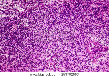 Fibrosarcoma, Malignant Tumor Of Fibroblasts, One Of Soft Tissue ...
