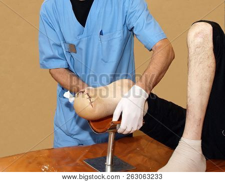 Stump After A Leg Amputation. Diabetic Foot Syndrome image & stock ...