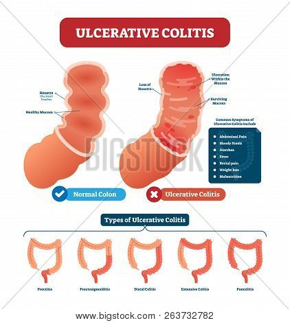 Ulcerative Colitis Vector Illustration. Labeled Anatomical Infographic ...