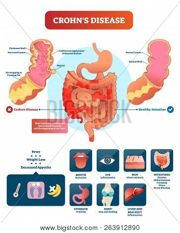 Crohns Disease Vector Illustration. Labeled Diagram With Diagnosis And ...