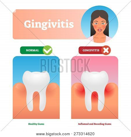 Gingivitis Vector Illustration. Medical Oral Mouth Illness Symptoms ...