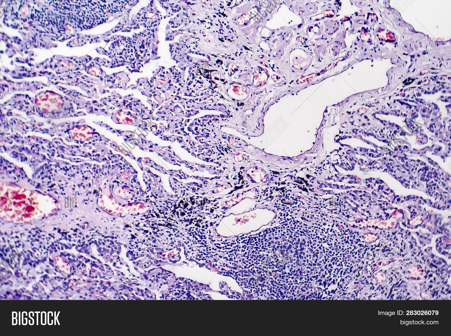 Histopathology Of Tuberculosis, Light Micrograph Of Tuberculosis Lesion ...
