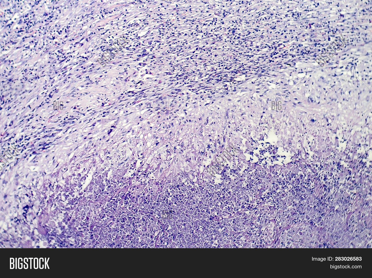 Histopathology Of Tuberculosis, Light Micrograph Of Tuberculosis Lesion ...