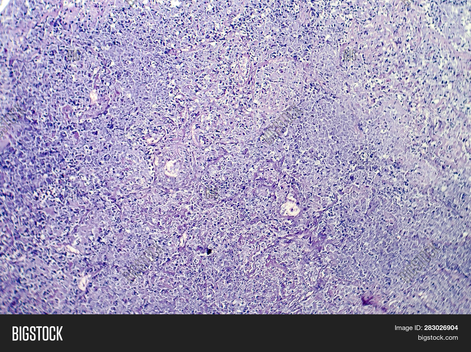 Histopathology Of Tuberculosis, Light Micrograph Of Tuberculosis Lesion ...