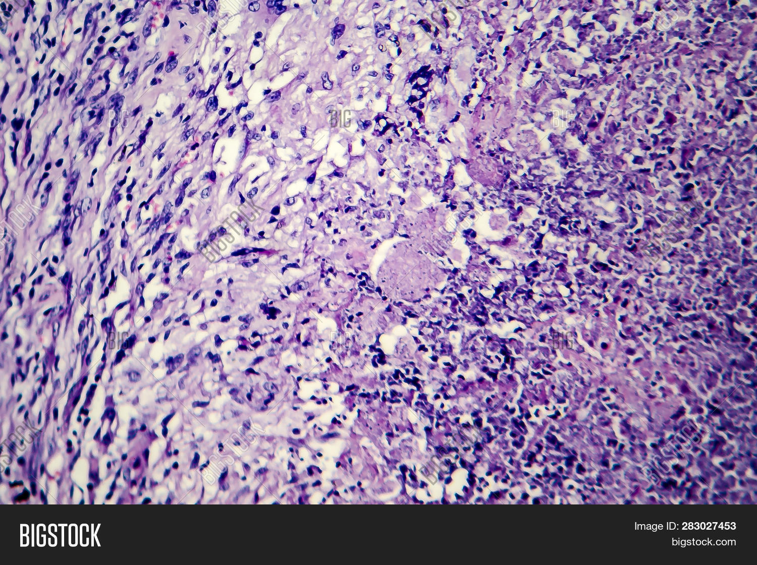 Histopathology Of Tuberculosis, Light Micrograph Of Tuberculosis Lesion ...