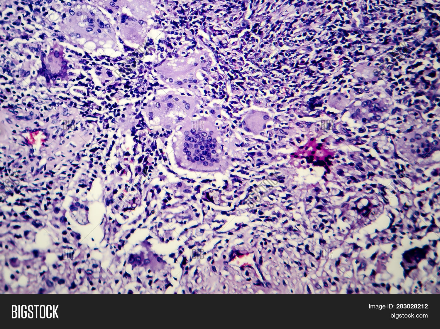 Histopathology Of Tuberculosis, Light Micrograph Of Tuberculosis Lesion ...