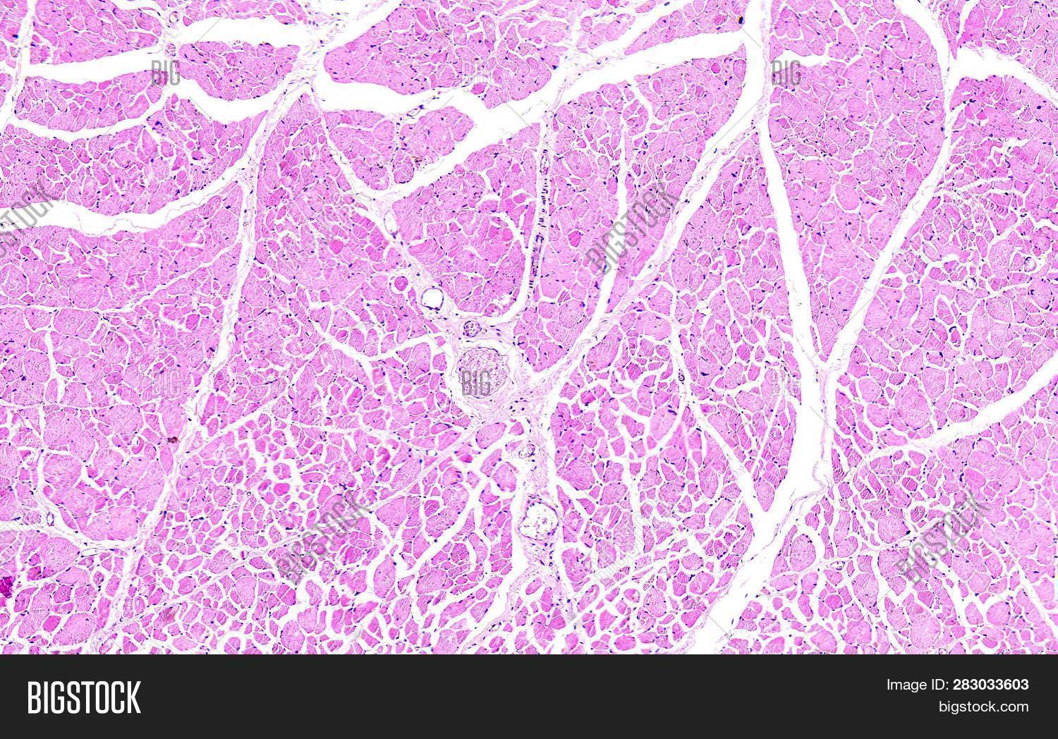 Histology Of Human Tissue, Show Necrosis Of Skeletal Muscle As Seen ...