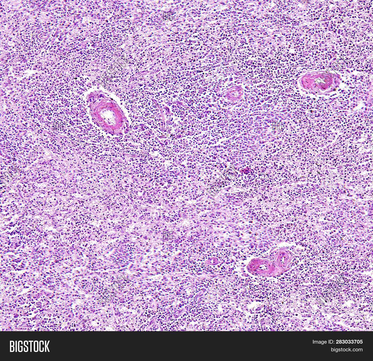 Histology Of Human Tissue, Show Central Artery Hyaline Degeneration Of ...
