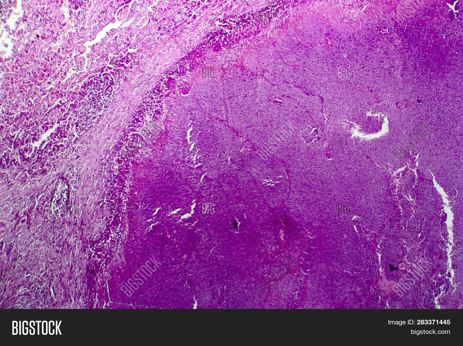 Caseation Of Human Tuberculosis Granuloma, Light Micrograph, Photo ...