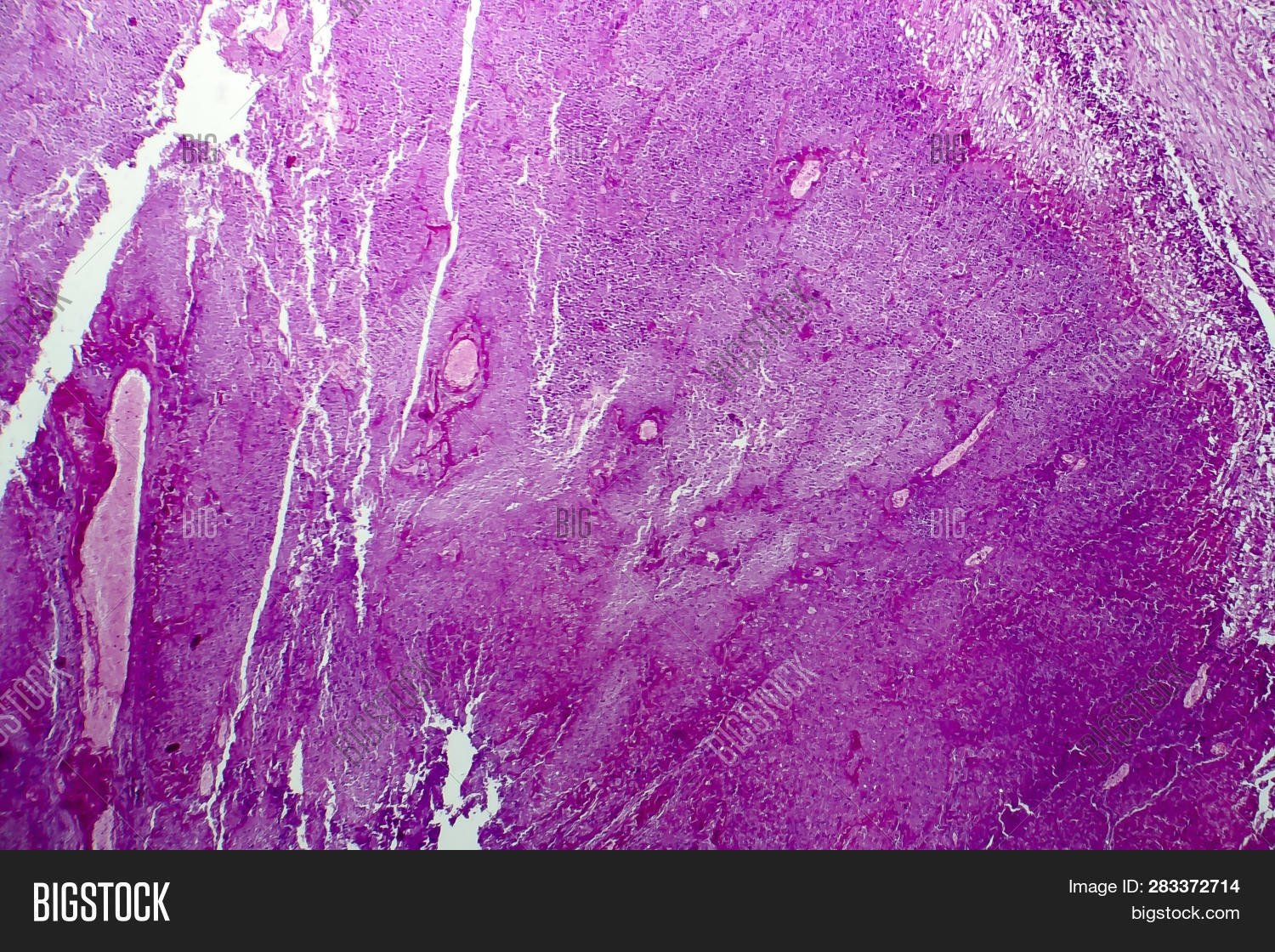 Caseation Of Human Tuberculosis Granuloma, Light Micrograph, Photo ...