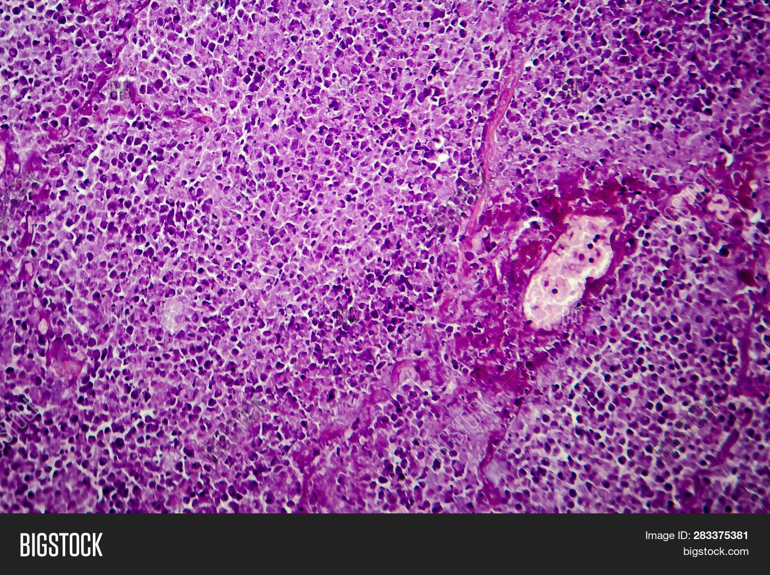 Caseation Of Human Tuberculosis Granuloma, Light Micrograph, Photo ...