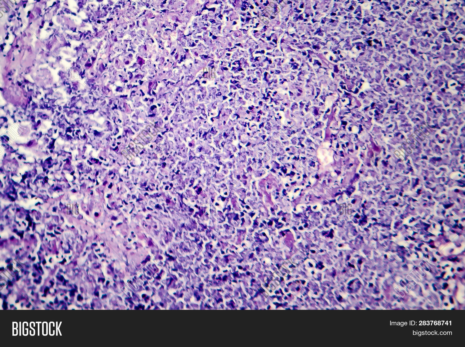 Histopathology Of Tuberculosis, Light Micrograph Of Tuberculosis Lesion ...