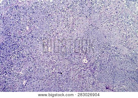 Histopathology Of Tuberculosis, Light Micrograph Of Tuberculosis Lesion ...