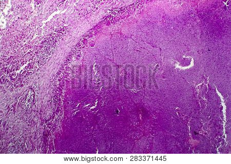 Caseation Of Human Tuberculosis Granuloma, Light Micrograph, Photo ...